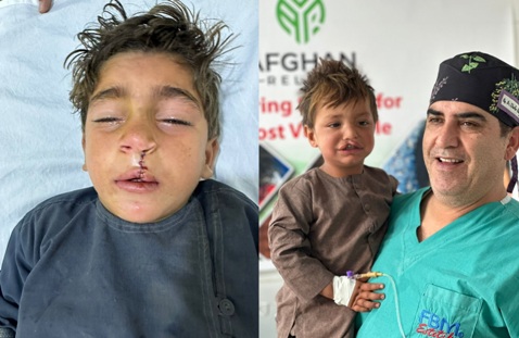 Surgeries of 106 children with cleft lip, palate conducted in Helmand